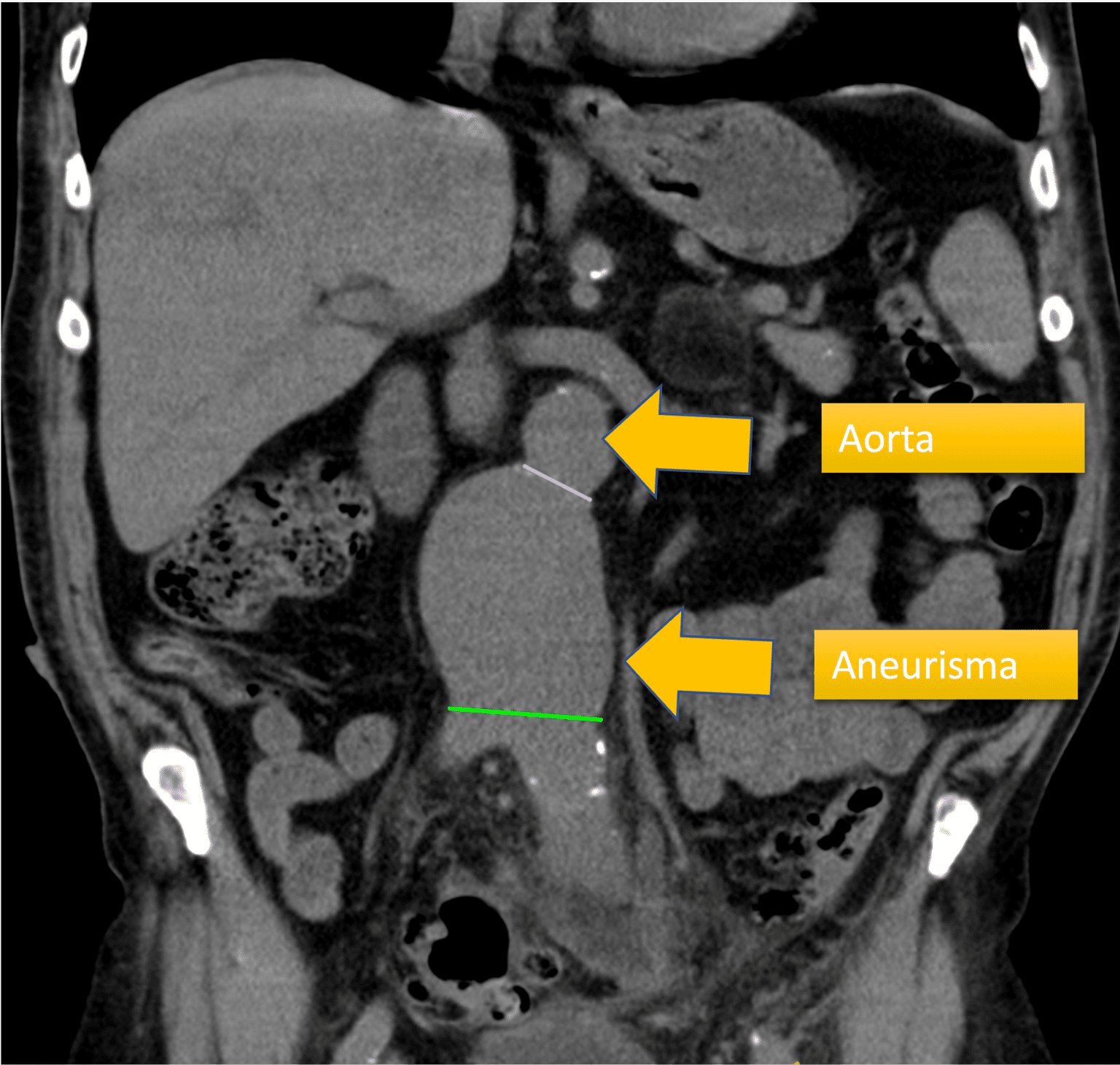 Aneurisma de Aorta Abdominal 🎈- Clinica Vena Sana
