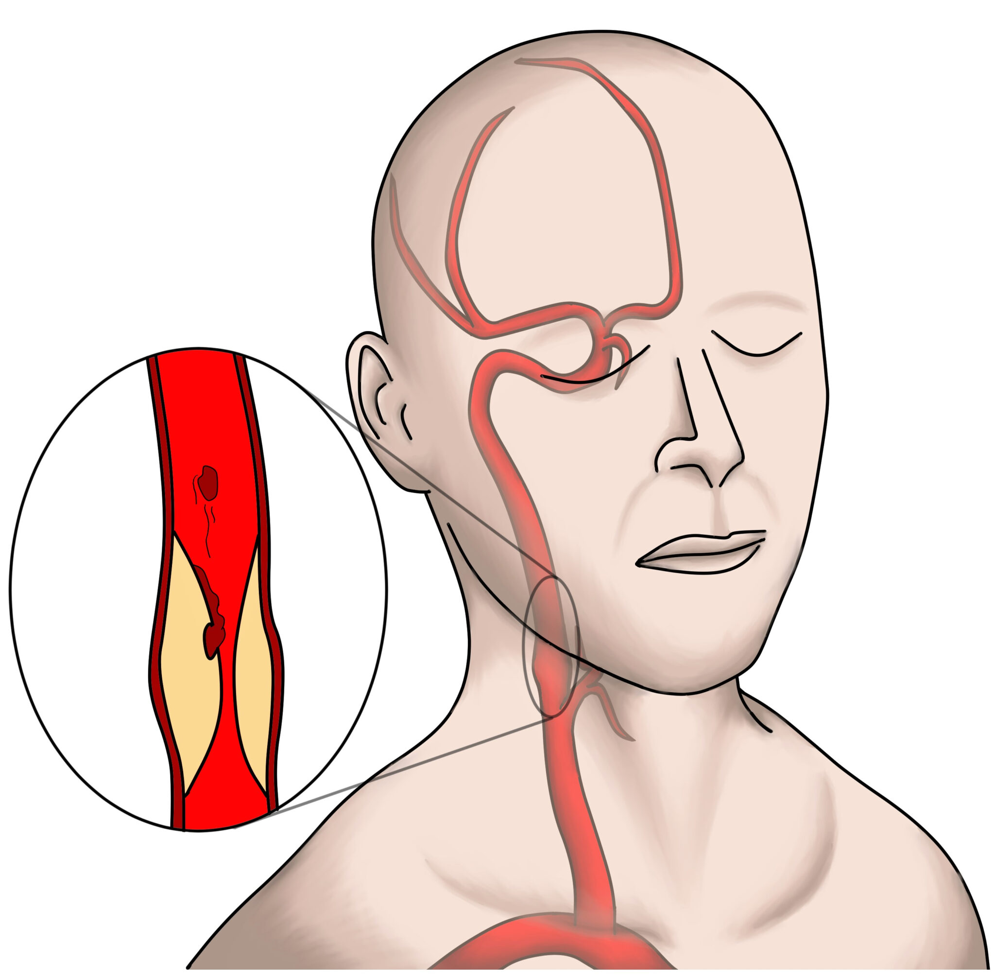 Enfermedad carotidea 🚨 - Clinica Vena Sana 🏥